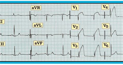 Ecg Interpretation Ecg Interpretation Review 82 Acute Stemi Rca Lad Circumflex Acute