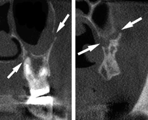 Maxillary Tuberosity Hyperplasia At Michael Sizemore Blog