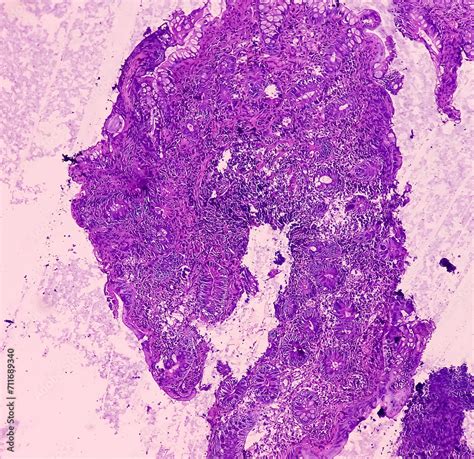 Ileo Cecal Ulcer Biopsy Chronic Nonspecific Ileitis With Ulcer Section Show Ileal Mucosa
