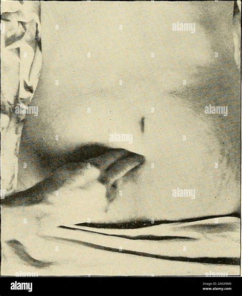 The Diagnosis And Treatment Of Diseases Of Women Mmation Tumor Extrauterine Pregnan Cy The