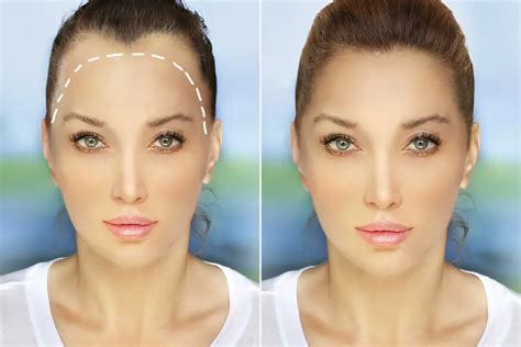 Specialized Female Hair Transplants At Dr Dieps Clinic Restore Your