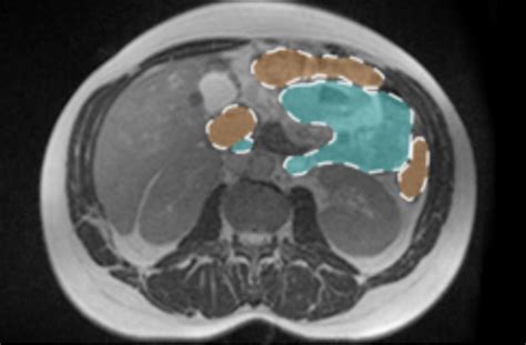 Figure 1 From Segmentation Of The Gastrointestinal Tract Mri Using Deep Learning Semantic Scholar