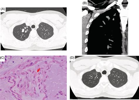 A B Chest Computed Tomography Ct At The First Visit Download Scientific Diagram