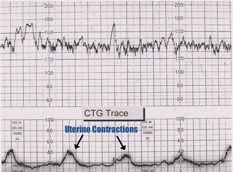 How To Read A Ctg Geeky Medics