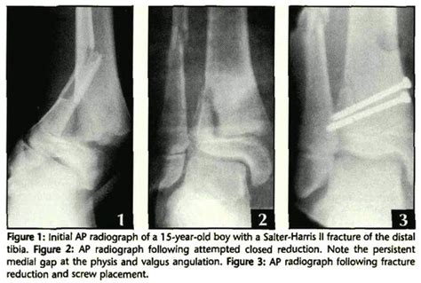 Distal Tibia Fracture Classification