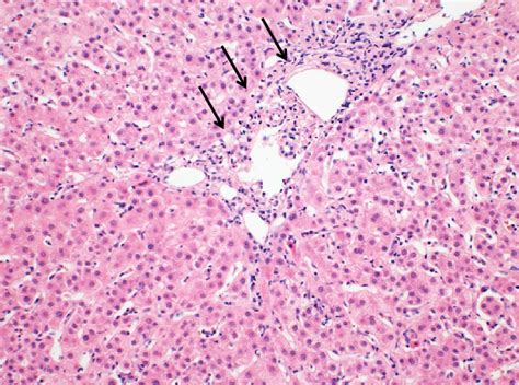 Microscopic Findings Showing Mild Portal Inflammation Arrows With Download Scientific