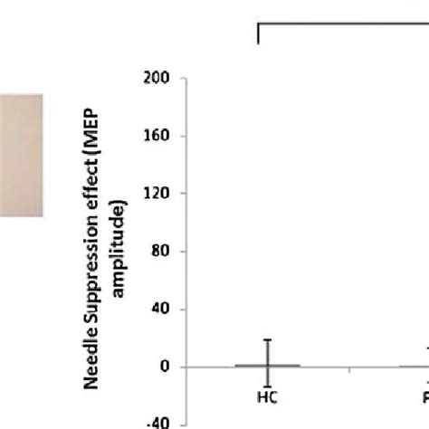 Correlation Between Needle Suppression Effect In The Fdi Muscle And Download Scientific Diagram