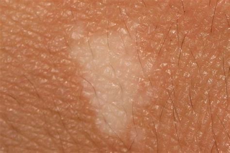 尋常性白斑 Geekなぺーじ