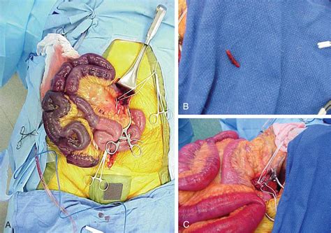 Mesenteric Ischemia Clinical Tree