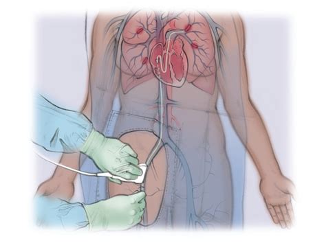 Pulmonary Embolism — The Interventional Initiative