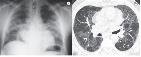 Restrictive Lung Disease Flashcards Quizlet