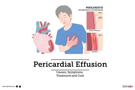Pericardial Effusion Causes Symptoms Treatment And Cost Pericardial Effusion Causes Symptoms Treatment And Cost