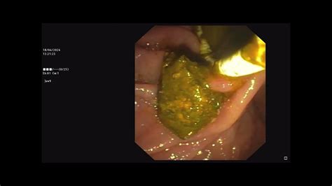 Ercp In Periampullary Diverticulum Cannulation Sphincterotomy And