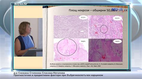 Прогностични и предиктивни фактори при бъбречноклетъчен карцином Youtube