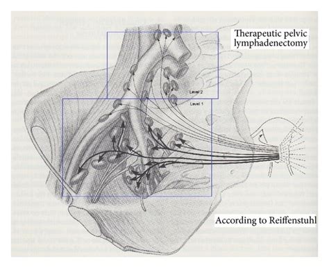 A Identification Of The Hypogastric Superior Plexus At The Aortic Download Scientific Diagram