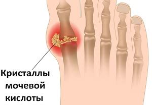 Питание и диета при подагре и повышенной мочевой кислоте: продукты для ...