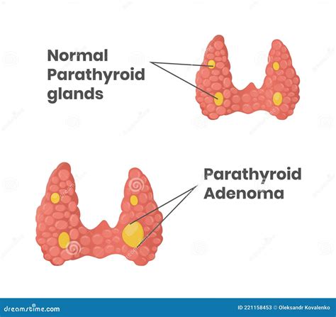 Thyroid Nodules And Parathyroid Problems Lqnun