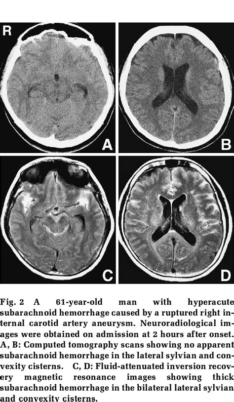 A 43 Year Old Man With Hyperacute Subarachnoid Hemorrhage Caused By A