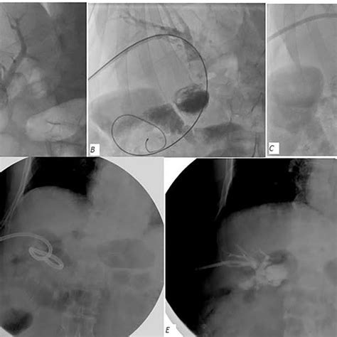 Pdf Percutaneous Transhepatic Laser Lithotripsy For Biliary Stones In Patients With Altered