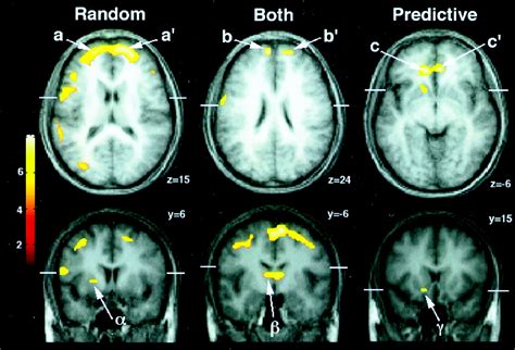 Dorsomedial Prefrontal Cortex