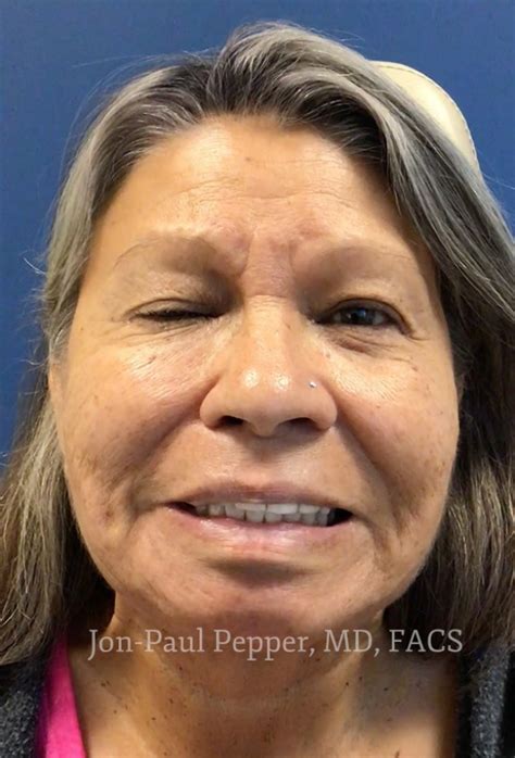 Before And After Gallery Otolaryngology⁠ — Head And Neck Surgery Stanford Medicine