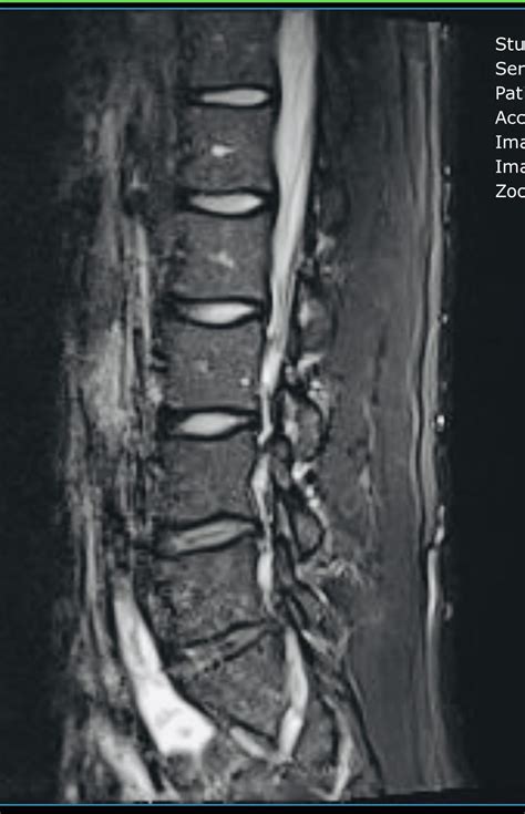 Spine Specialist Recommending Laminectomy And Fusion L4l5s1 Rsciatica