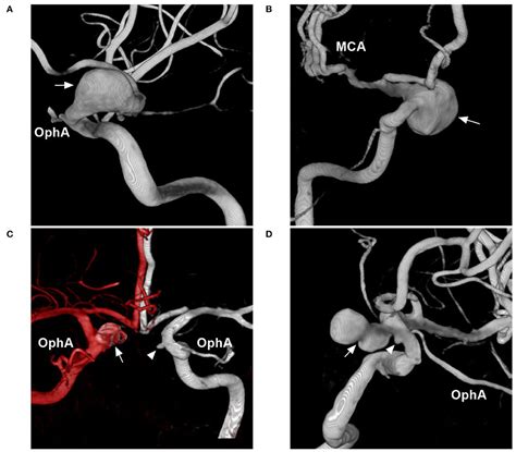 Frontiers Endovascular Treatment Of Aneurysms Of The Paraophthalmic