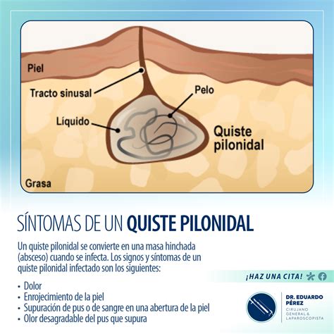 ⚠️ Quiste Pilonidal 2 Causas Y Dr Eduardo Pérez