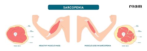 Understanding Sarcopenia The Role Of Protein Intake And Diet Roam
