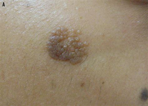 Lymphangioma Circumscriptum Scholars Journal Of Medical Case Reports