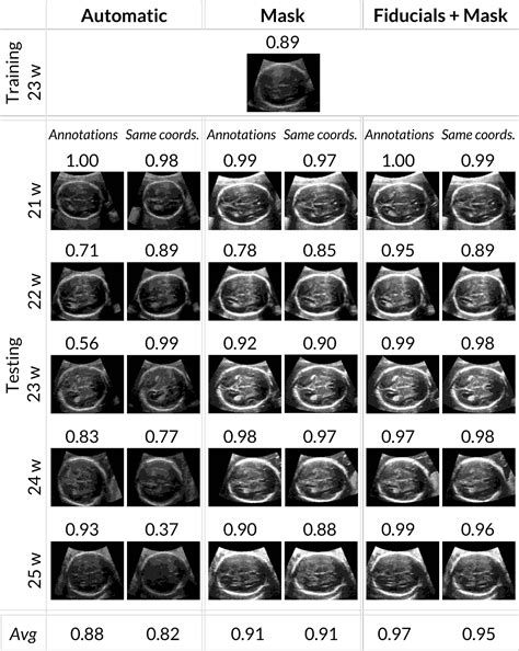 Learning Ultrasound Plane Pose Regression Assessing Generalized Pose Coordinates In The Fetal