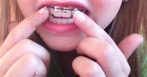 Warning Signs Of Diy Braces Andrew Skorobatckyj Dds Parme Oh