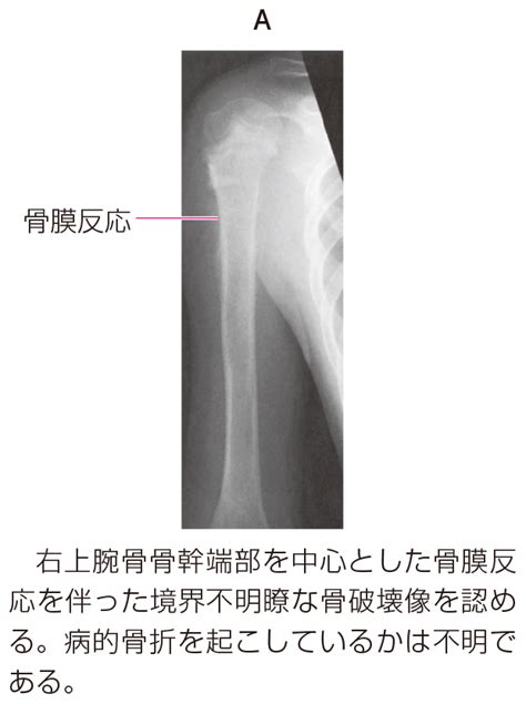 骨肉腫闘病記 骨肉腫 痛み 特徴 Dmpme