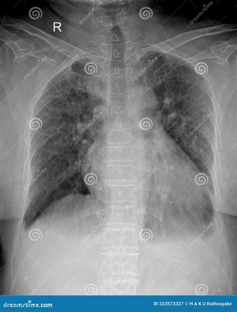 Chest X Ray A Radiographic Technique For Evaluating Thoracic Structures Royalty Free Stock