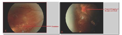 C Showing Exudates Beneath The Macula Area And D Shows Dragging Of The
