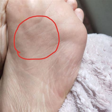 脚底板长小水泡很痒是怎么回事？鞋袜时候有效地