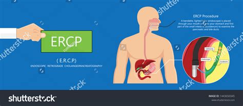 Endoscopic Retrograde Cholangiopancreatography Ercp Diagnose Treat 库存矢量图（免版税）1443650345