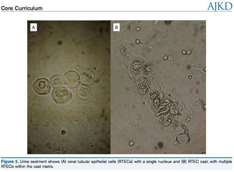 Transitional Renal Epithelial Cells In Urine