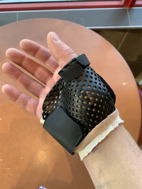 Dislocated Thumb Cmc Joint Toyota Tundra Forum