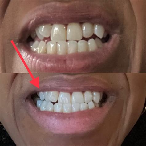 Subtle Progress At 8 Weeks Rinvisalign