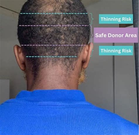 Overharvested Donor Area Causes And How To Fix It Longevita