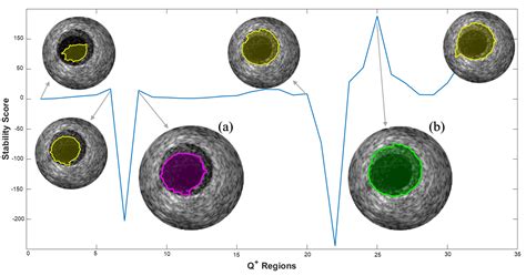 Segmentation Of Arterial Walls In Intravascular Ultrasound Cross Sectional Images Using Extremal