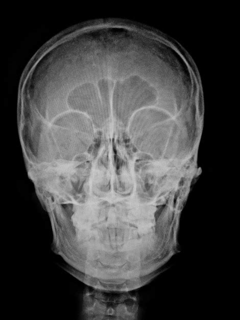 Uma Tomografia Computadorizada De Um Crânio Humano Com O Meio Do Crânio