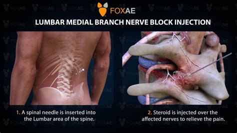 Medial Nerves Block Fox Animated Engineering