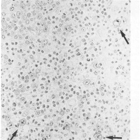 Second Lymph Node Biopsy Specimen Some Large Berh2 Cd30 Positive