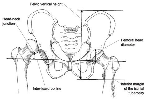 Adult Dysplasia Of The Hip Recon Orthobullets
