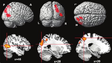 Shared Neural Activity In The Right Middle Temporal Gyrus Right Download Scientific Diagram