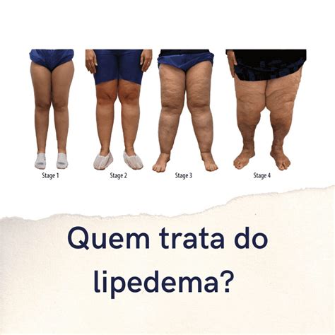 Como Tratar O Lipedema Zuledu