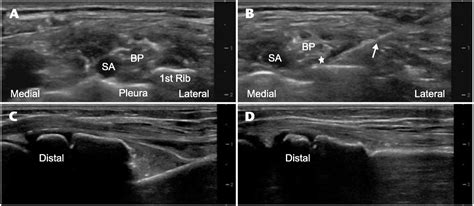 Ultrasound Guided Supraclavicular Brachial Plexus Blocks Per Pediatric Emergency Care