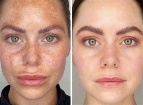 Chemical Peeling Nuo Advance Aesthetic